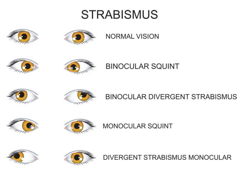 Muscle Surgery - Westside Eye Clinic of New Orleans
