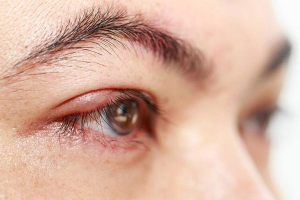 What is a Stye? - Westside Eye Clinic