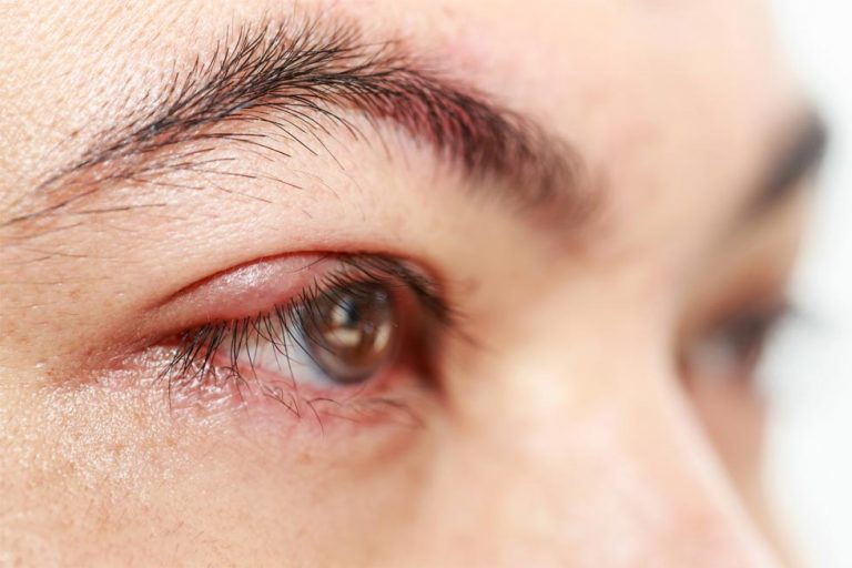 What is a Stye? - Westside Eye Clinic