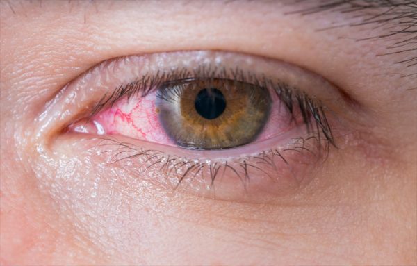 Pinkeye Information - Article by West Side Eye Clinic