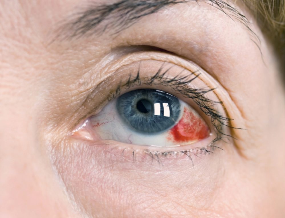 Can Spicy Foods Affect Your Eyesight? – Westside Eye Clinic